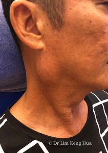 Neck Lumps - Dr KH Lim ENT Clinic