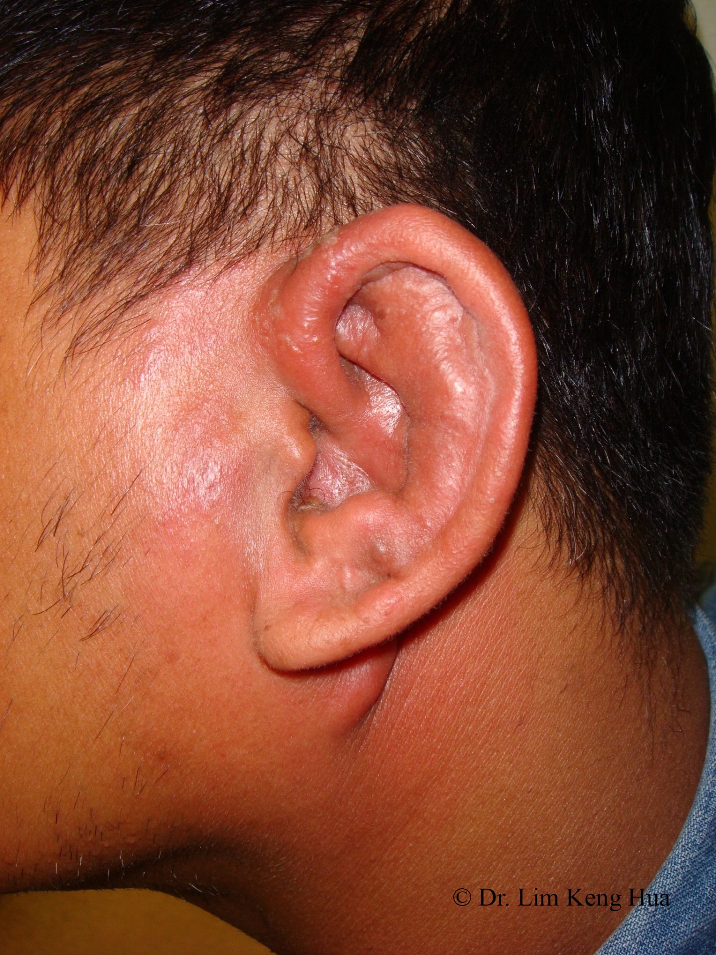 Ear Infections Dr Kh Lim Ent Clinic