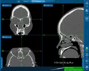 Sinus Specialist Singapore, Sinusitis Surgery & Treatment - Dr. KH Lim